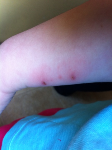 Dealing With Toddlers and Animal Bites